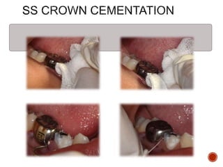 SS crown restoration | PPT