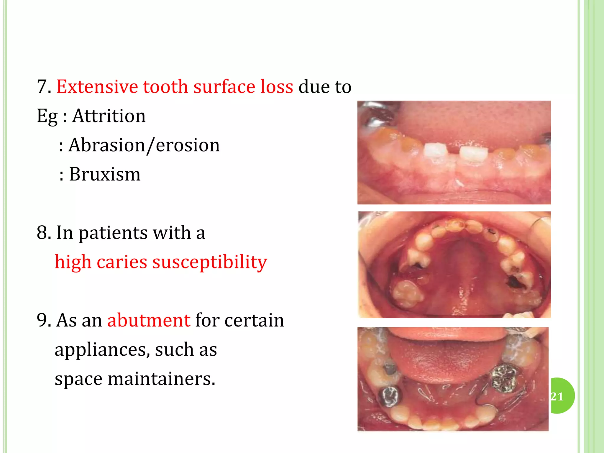 Stainless steel crowns in Pediatric Dentistry | PPTX | Oral care ...