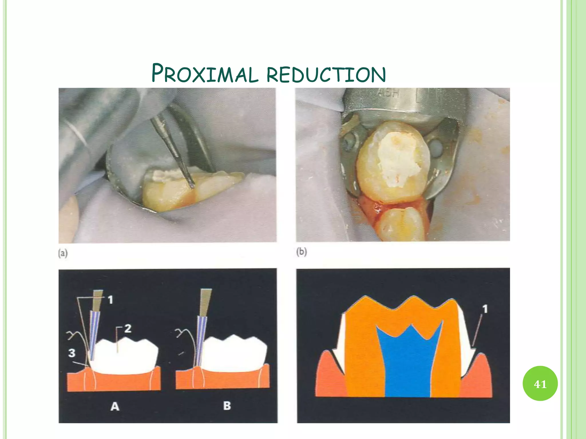 Stainless steel crowns in Pediatric Dentistry | PPTX | Oral care ...