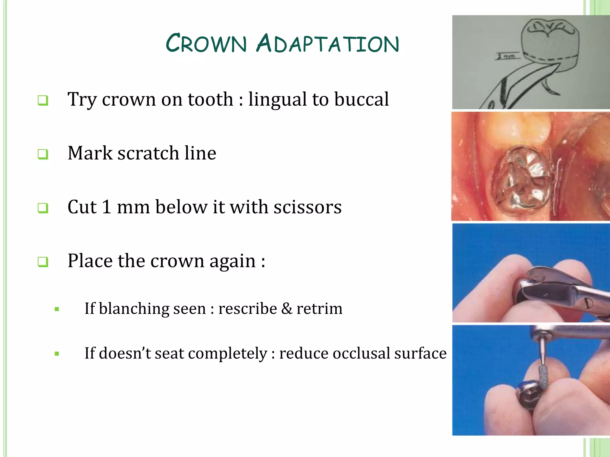Stainless steel crowns in Pediatric Dentistry | PPTX