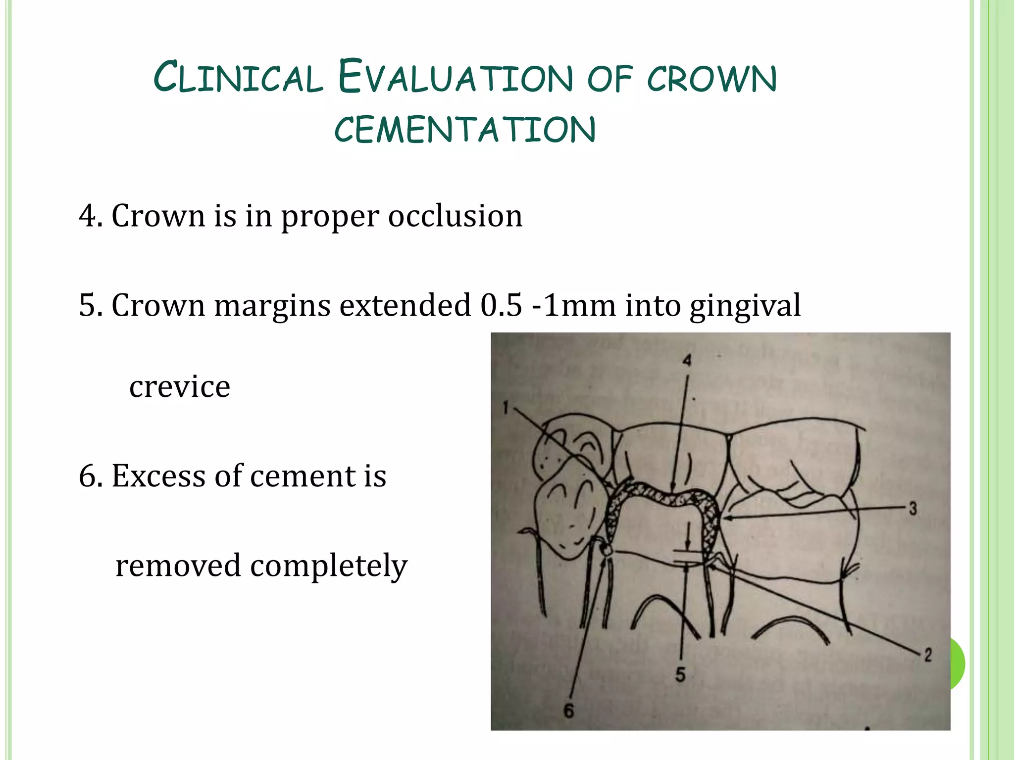 Stainless steel crowns in Pediatric Dentistry | PPTX