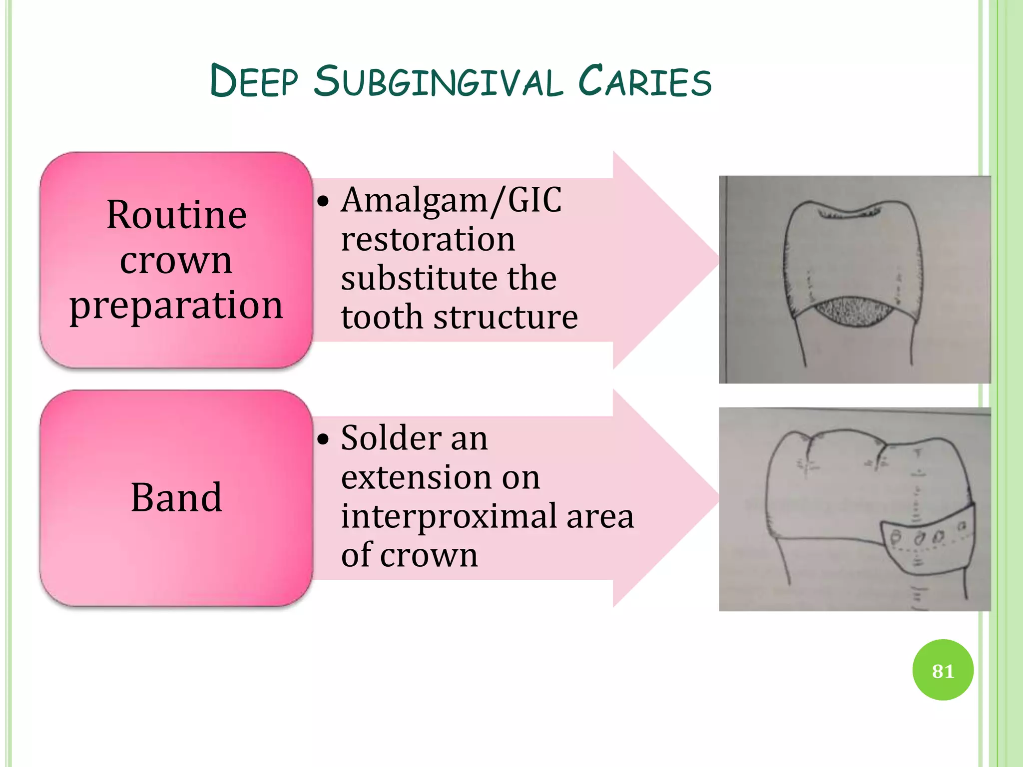 Stainless steel crowns in Pediatric Dentistry | PPTX