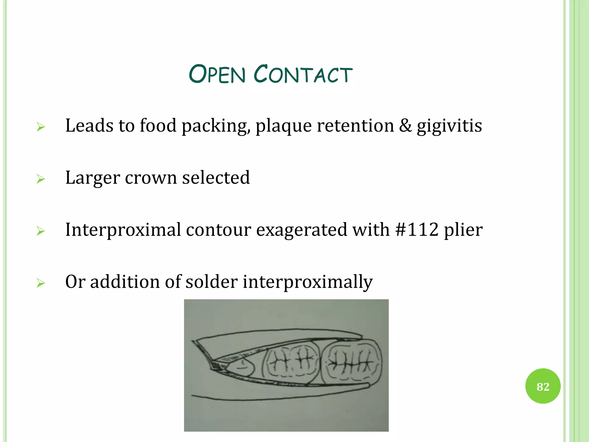 Stainless steel crowns in Pediatric Dentistry | PPTX