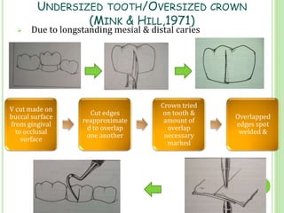 Stainless steel crowns in Pediatric Dentistry | PPTX