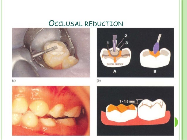 Stainless steel crowns in Pediatric Dentistry