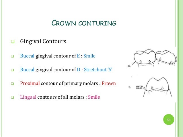 Stainless steel crowns in Pediatric Dentistry