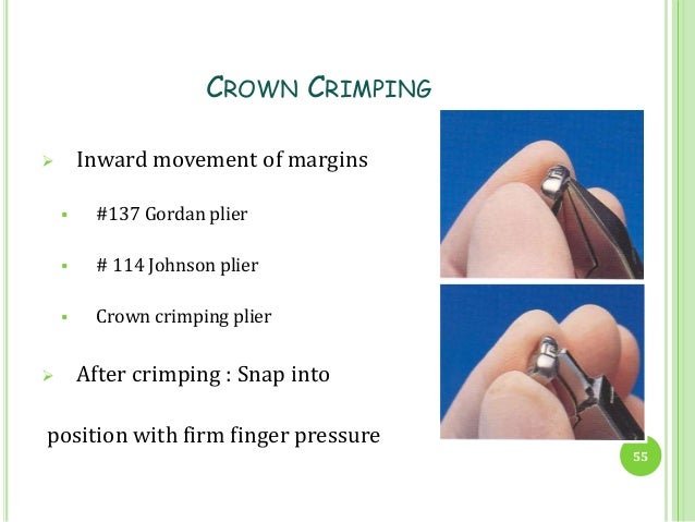 Stainless steel crowns in Pediatric Dentistry