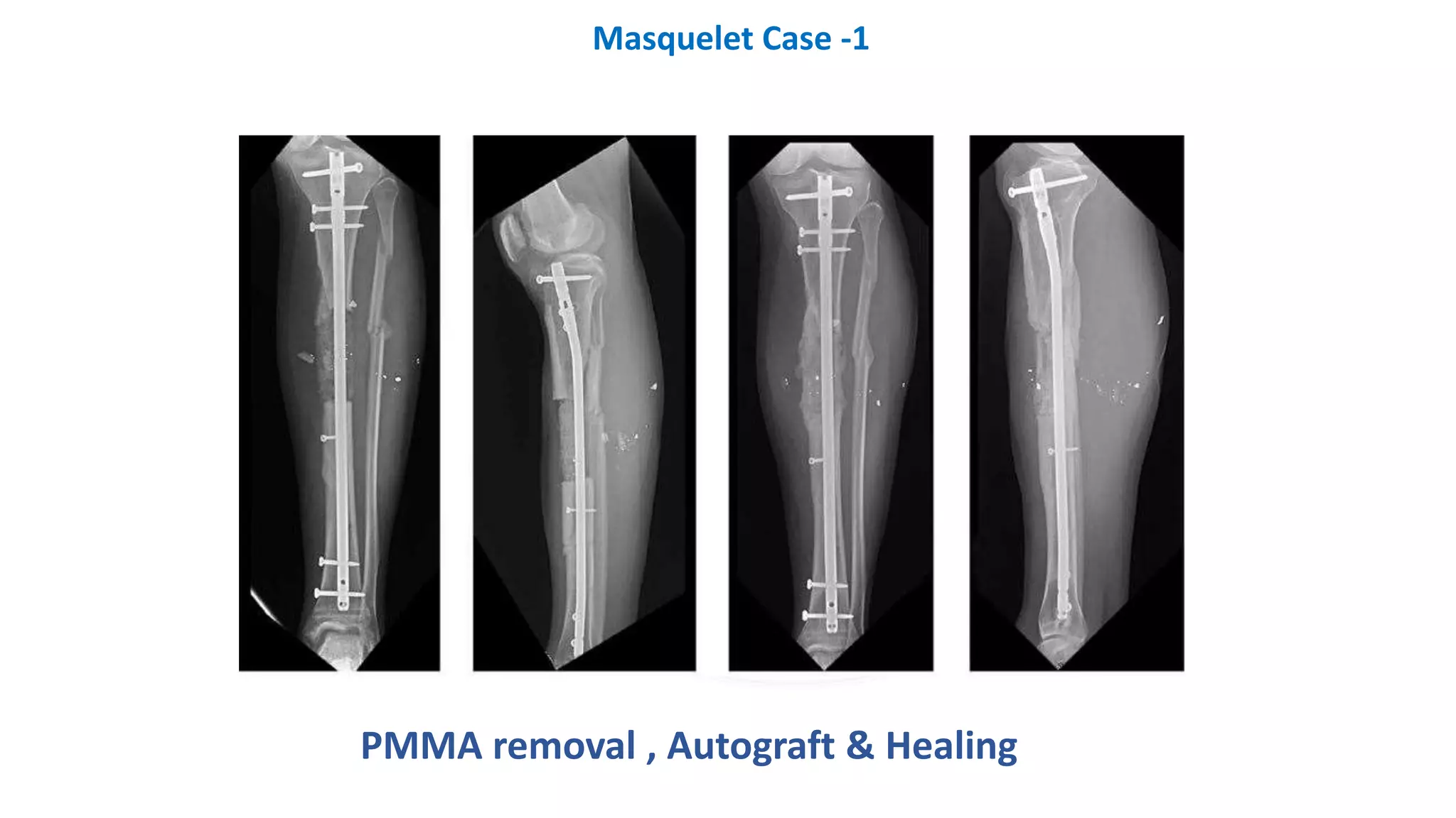 Management of Bone Defects | PPTX