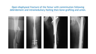 Management of Bone Defects | PPTX