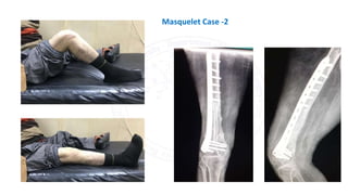 Management of Bone Defects | PPTX