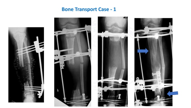 Management of Bone Defects | PPTX