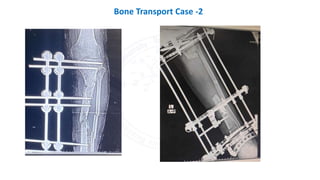 Management of Bone Defects | PPTX