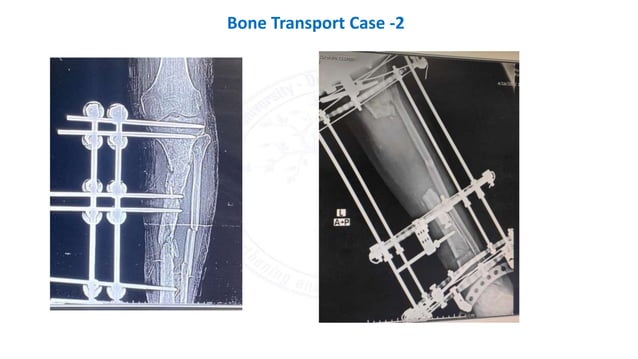 Management of Bone Defects | PPTX