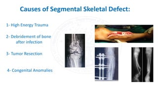 Management of Bone Defects | PPTX
