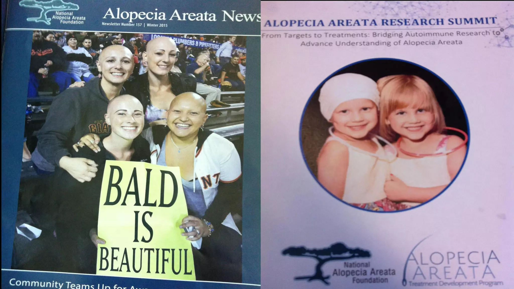 SSEA-Positive Myeloid Cells are Involved in Hair Loss in the Alopecia ...