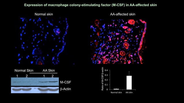 SSEA-Positive Myeloid Cells are Involved in Hair Loss in the Alopecia ...