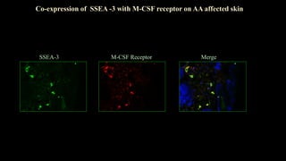 SSEA-Positive Myeloid Cells are Involved in Hair Loss in the Alopecia ...