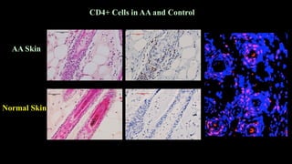 SSEA-Positive Myeloid Cells are Involved in Hair Loss in the Alopecia ...