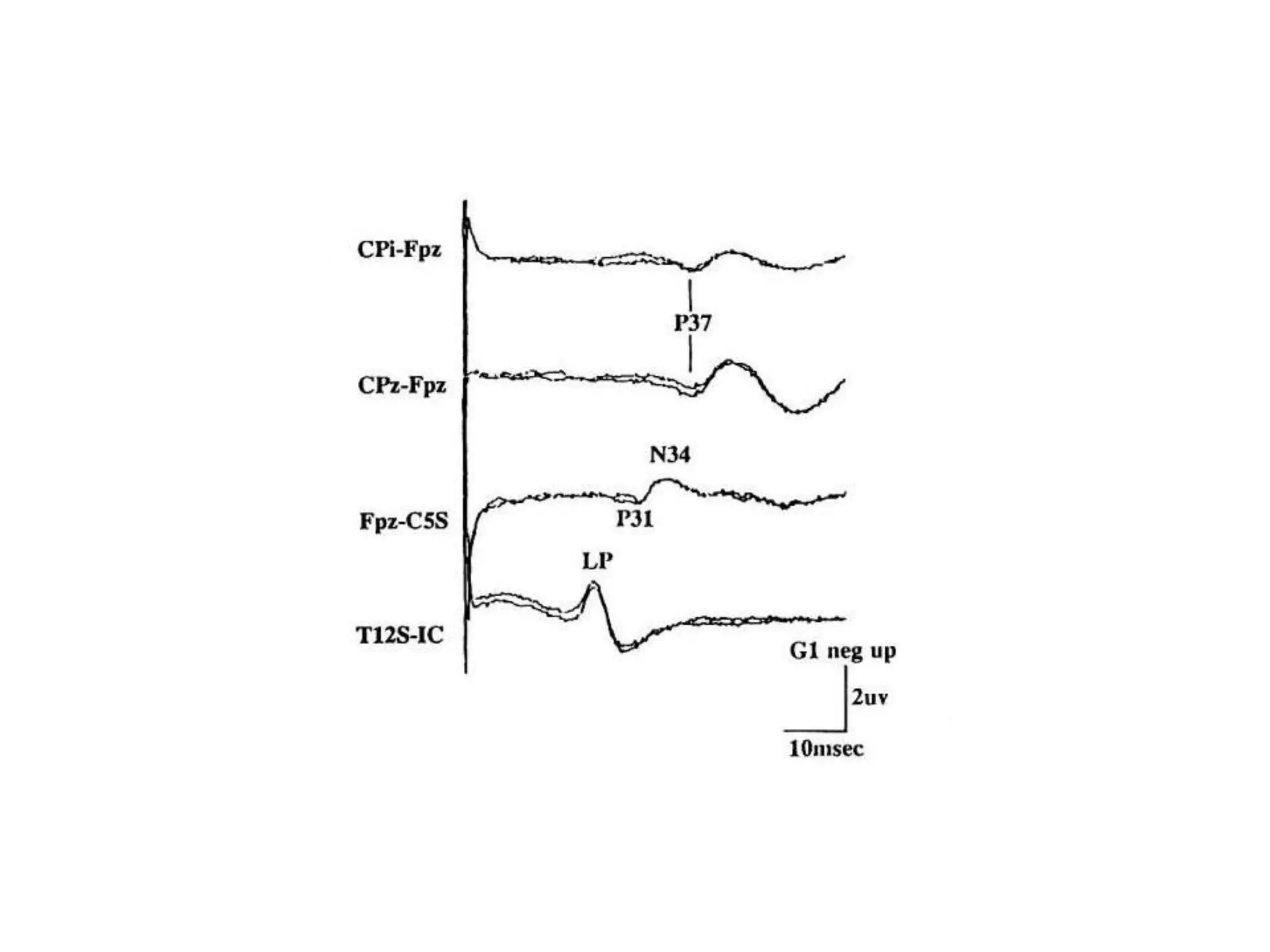 Somato Sensory Evoked Potentials (SSEP) By: Murtaza Syed | PPTX