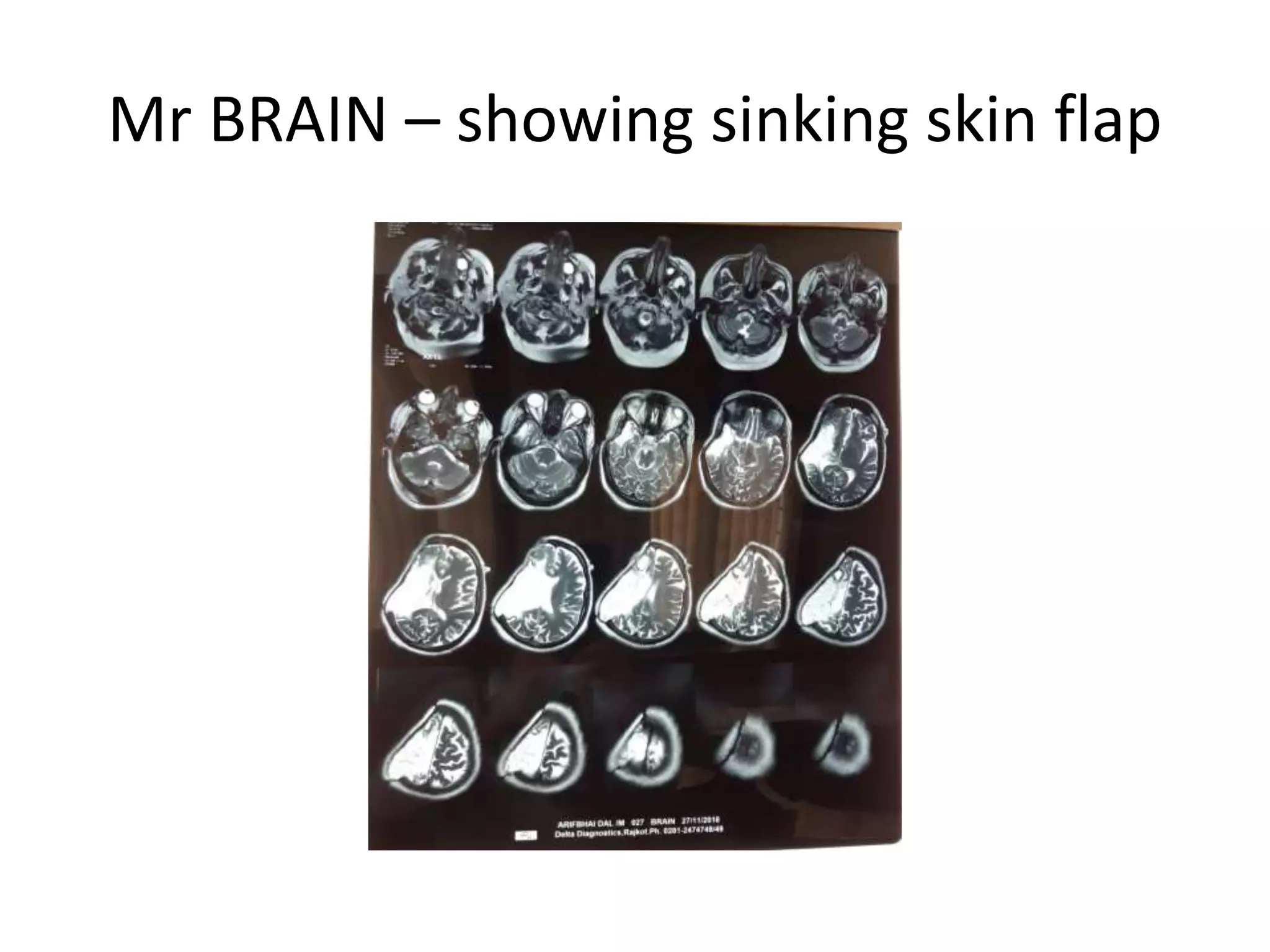 Sinking Skin Flap Syndrome | PPTX