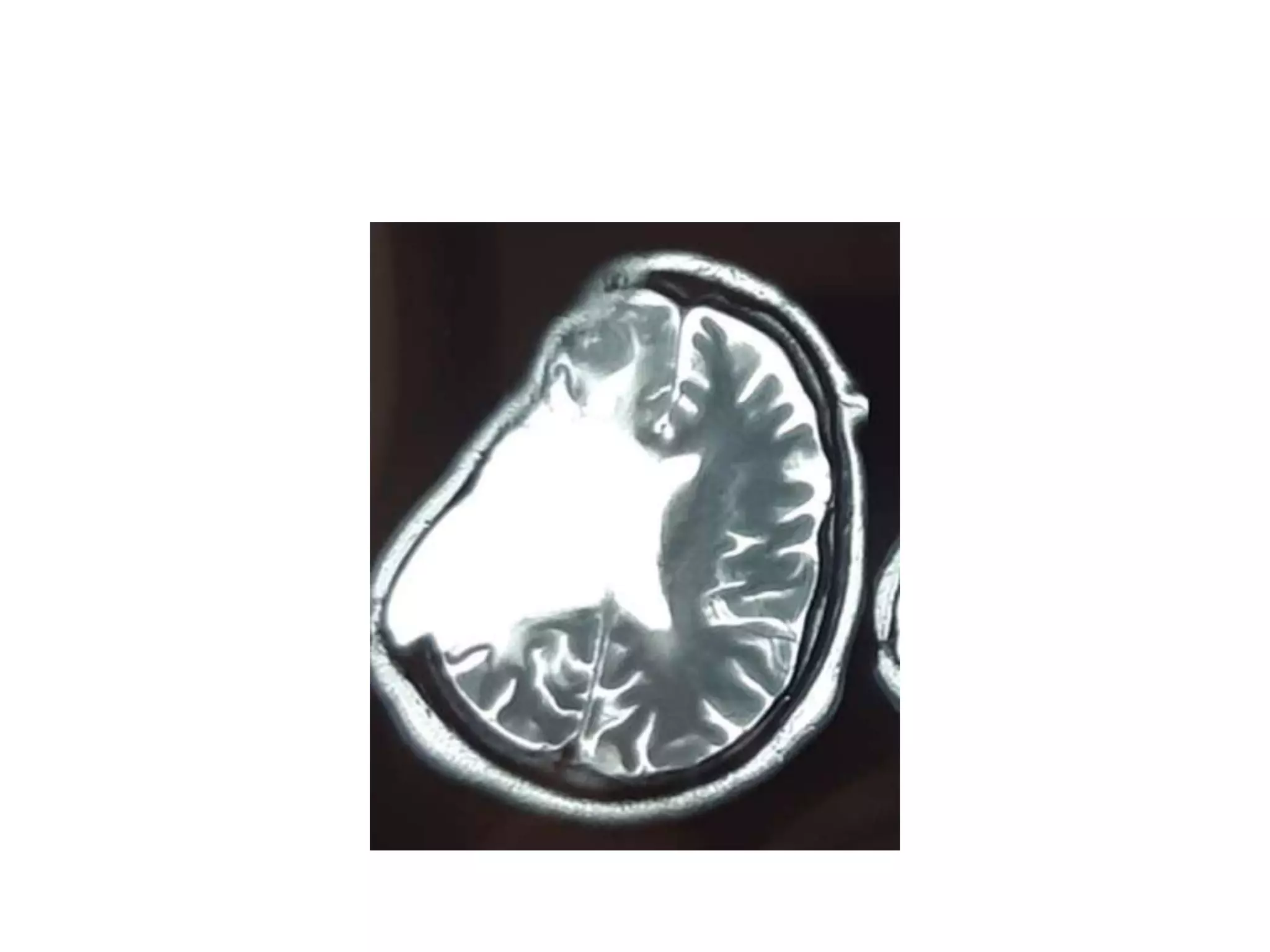 Sinking Skin Flap Syndrome | PPTX