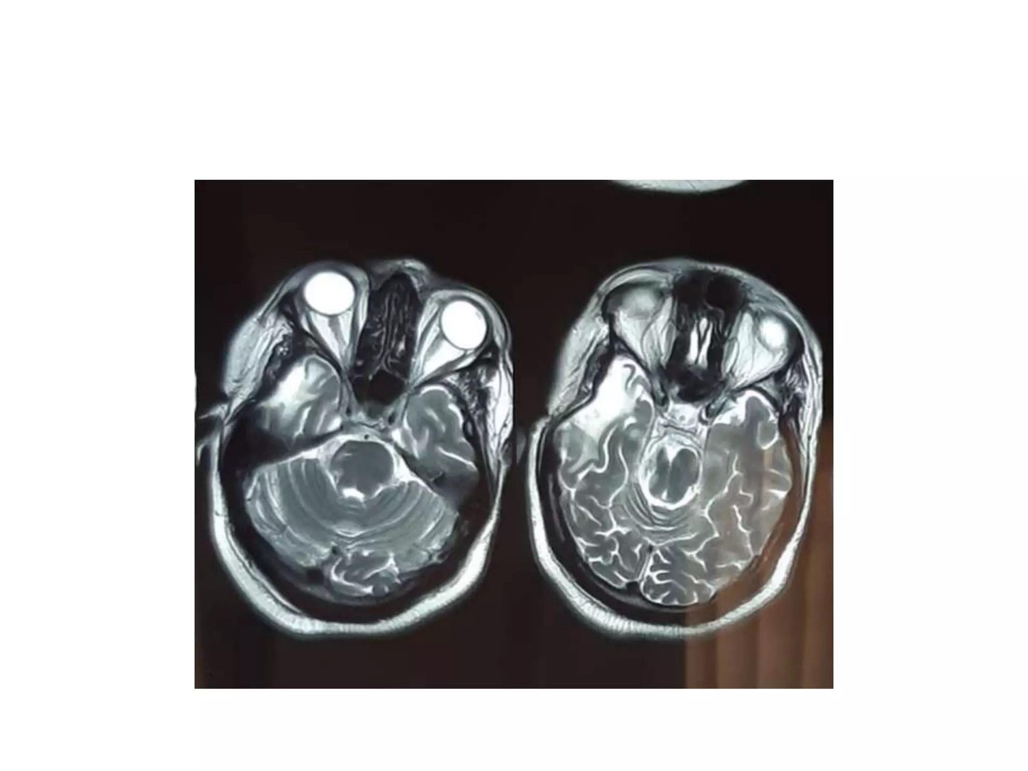 Sinking Skin Flap Syndrome | PPTX