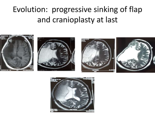 Sinking Skin Flap Syndrome
