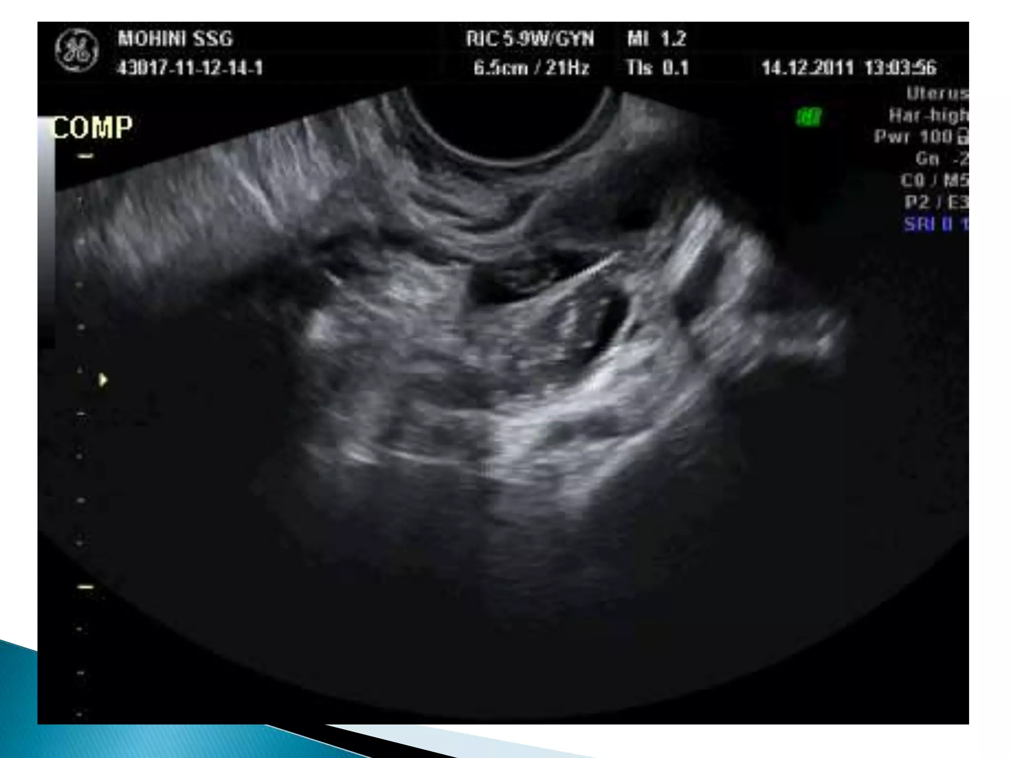 SONOSALPINGOGRAPHY STEPS BY LATE DR SAKSHI | PPTX