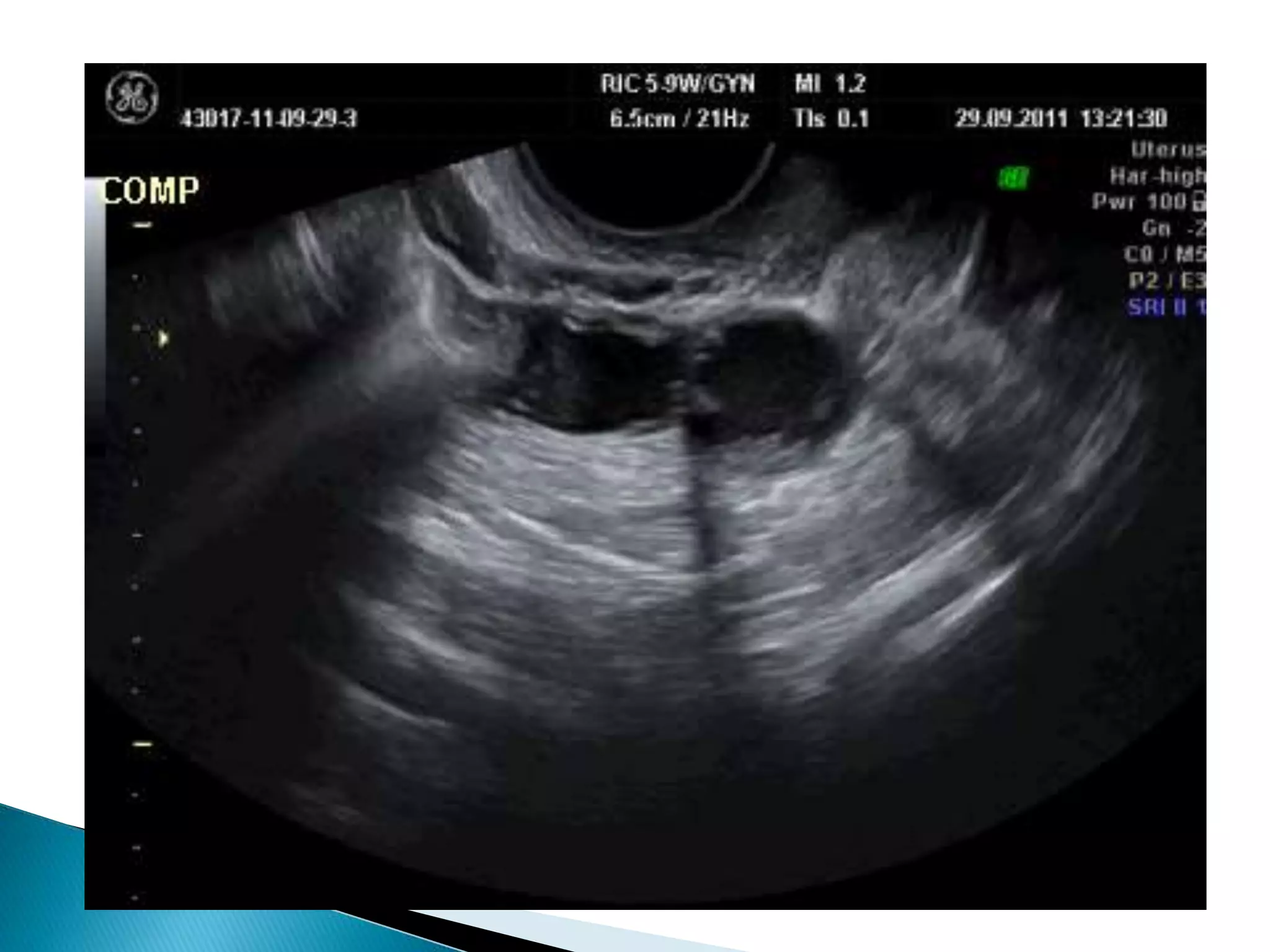 SONOSALPINGOGRAPHY STEPS BY LATE DR SAKSHI | PPTX