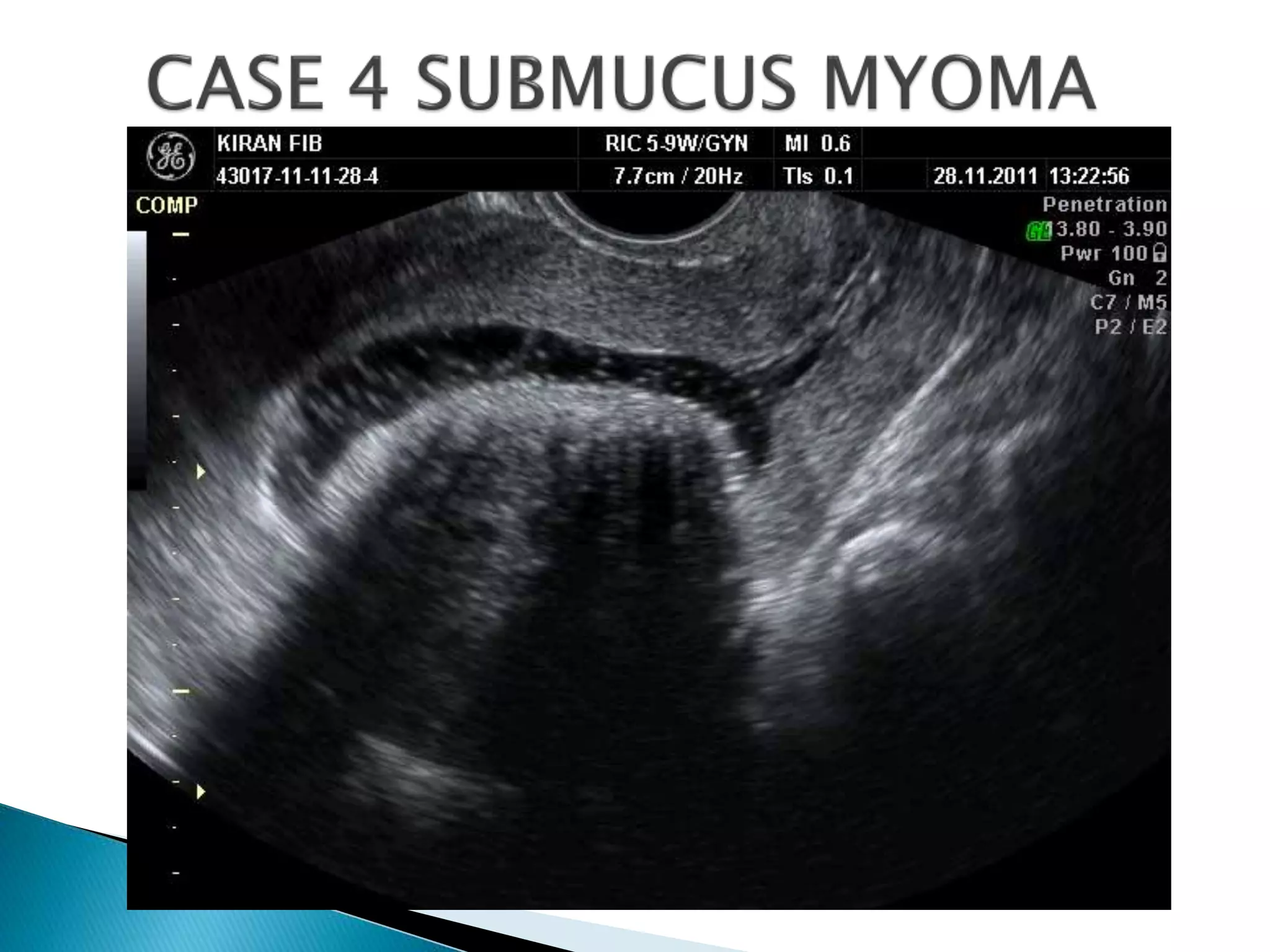 SONOSALPINGOGRAPHY STEPS BY LATE DR SAKSHI | PPTX