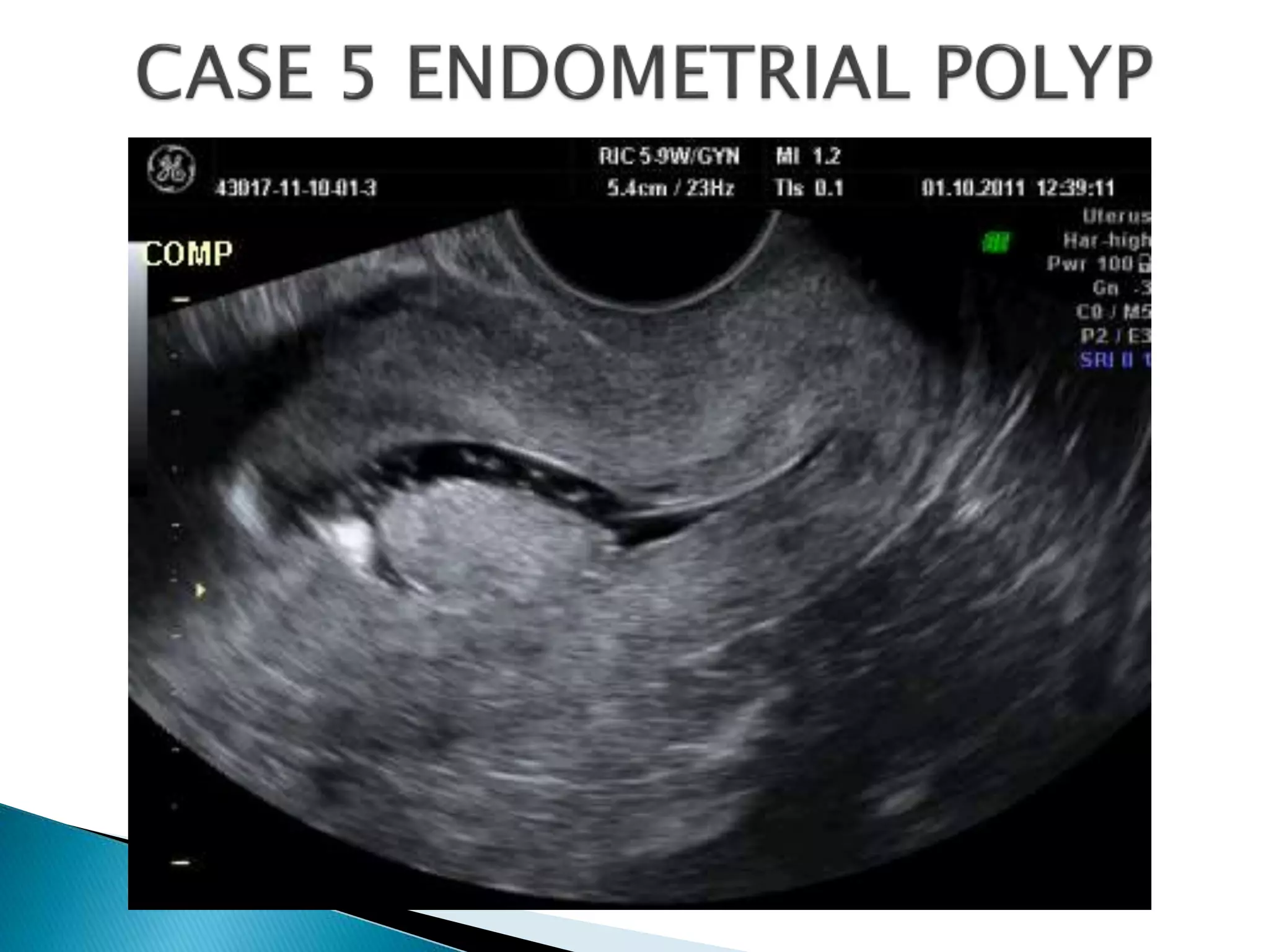 SONOSALPINGOGRAPHY STEPS BY LATE DR SAKSHI | PPTX