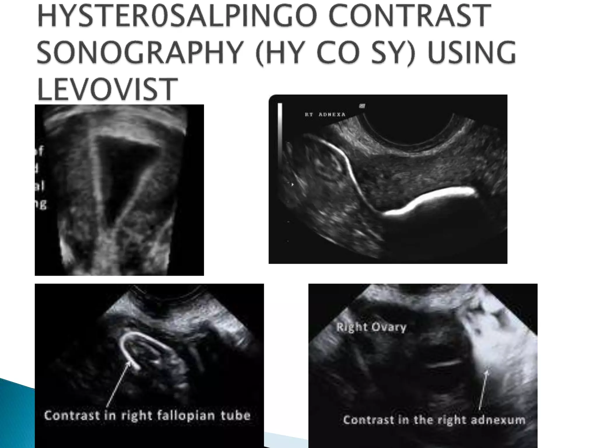 SONOSALPINGOGRAPHY STEPS BY LATE DR SAKSHI | PPTX