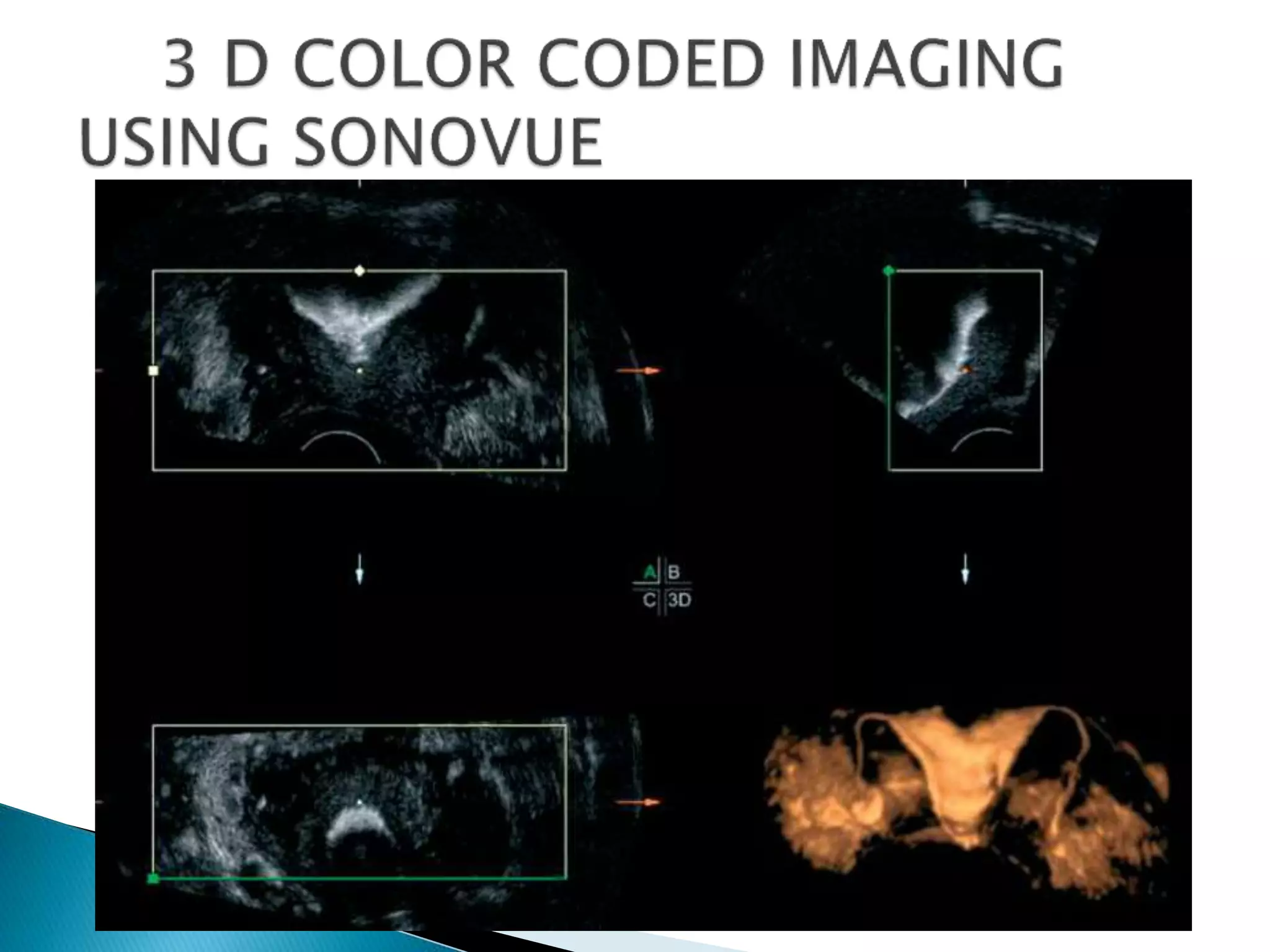 SONOSALPINGOGRAPHY STEPS BY LATE DR SAKSHI | PPTX