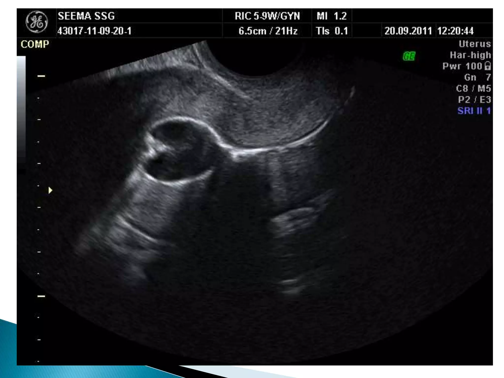 SONOSALPINGOGRAPHY STEPS BY LATE DR SAKSHI | PPTX