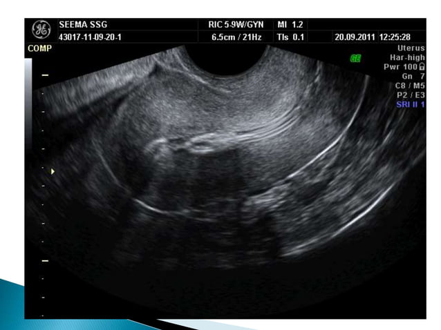 SONOSALPINGOGRAPHY STEPS BY LATE DR SAKSHI | PPT
