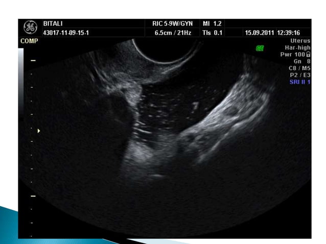 SONOSALPINGOGRAPHY STEPS BY LATE DR SAKSHI | PPT