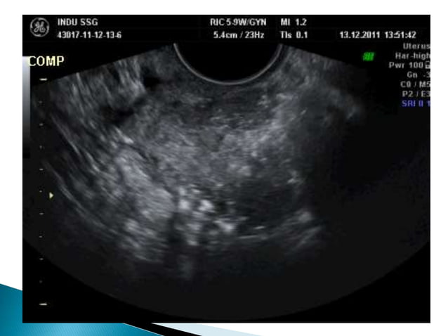 SONOSALPINGOGRAPHY STEPS BY LATE DR SAKSHI | PPT