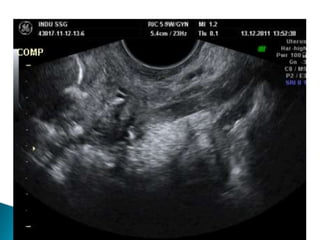 SONOSALPINGOGRAPHY STEPS BY LATE DR SAKSHI | PPTX
