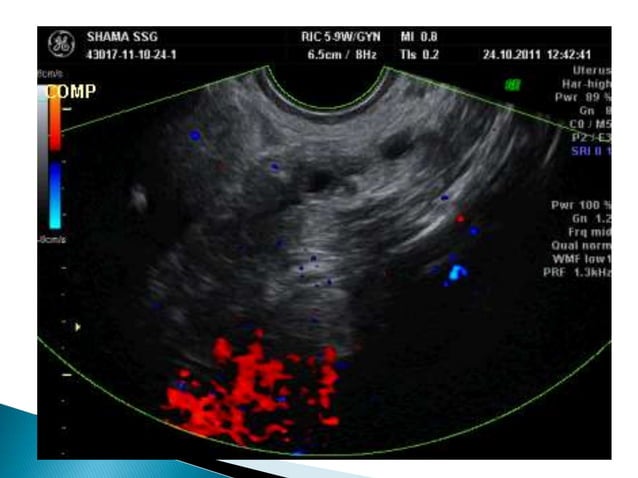 SONOSALPINGOGRAPHY STEPS BY LATE DR SAKSHI | PPT