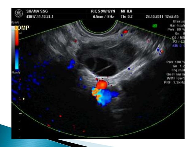 SONOSALPINGOGRAPHY STEPS BY LATE DR SAKSHI | PPT