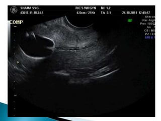 SONOSALPINGOGRAPHY STEPS BY LATE DR SAKSHI | PPTX