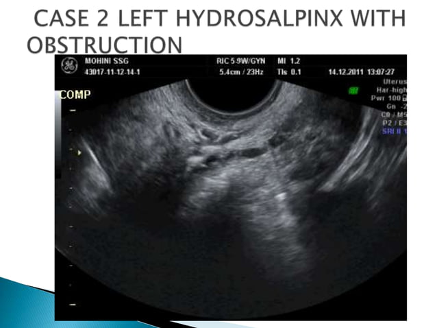 SONOSALPINGOGRAPHY STEPS BY LATE DR SAKSHI | PPT