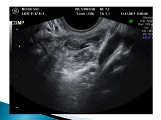 SONOSALPINGOGRAPHY STEPS BY LATE DR SAKSHI | PPTX