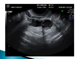 SONOSALPINGOGRAPHY STEPS BY LATE DR SAKSHI | PPTX