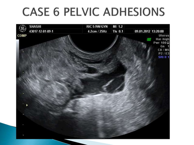 SONOSALPINGOGRAPHY STEPS BY LATE DR SAKSHI | PPT