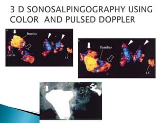 SONOSALPINGOGRAPHY STEPS BY LATE DR SAKSHI | PPTX