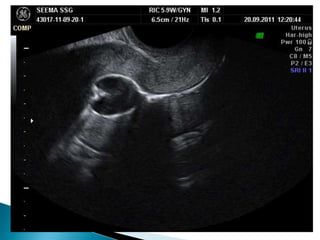 SONOSALPINGOGRAPHY STEPS BY LATE DR SAKSHI | PPTX