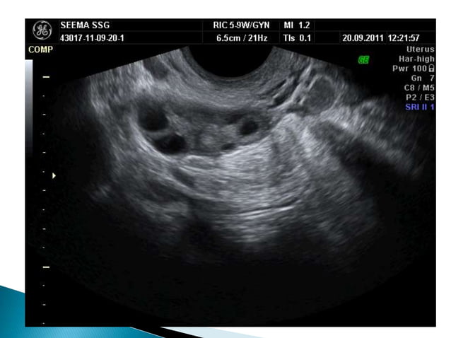 SONOSALPINGOGRAPHY STEPS BY LATE DR SAKSHI | PPT