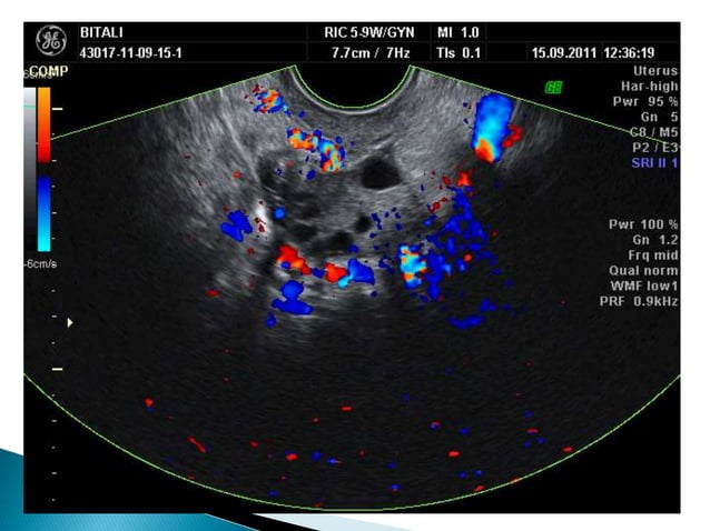 SONOSALPINGOGRAPHY STEPS BY LATE DR SAKSHI | PPT