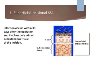 Surgical Site infections | PPT